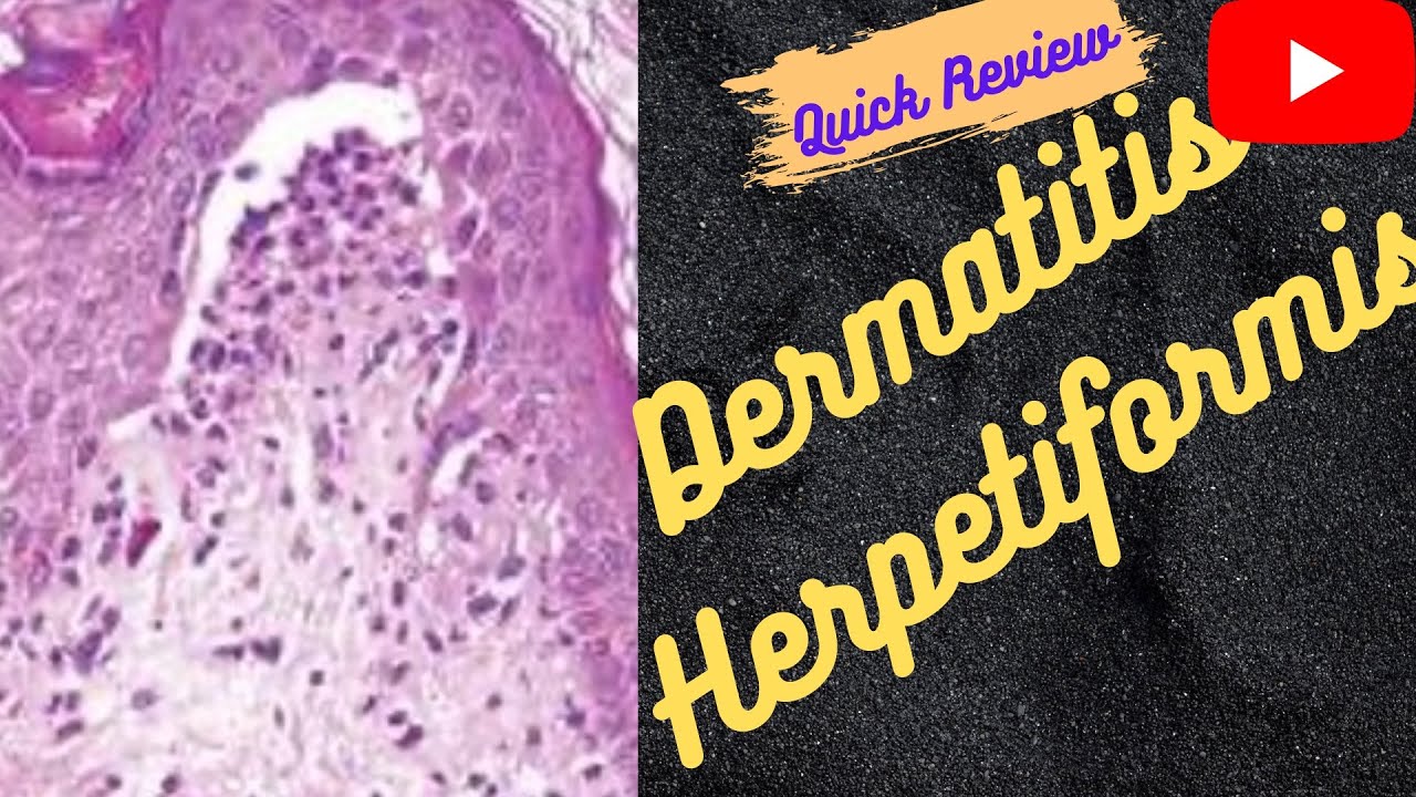 Dermatitis Herpetiformis|What does herpetiformis dermatitis look like ...