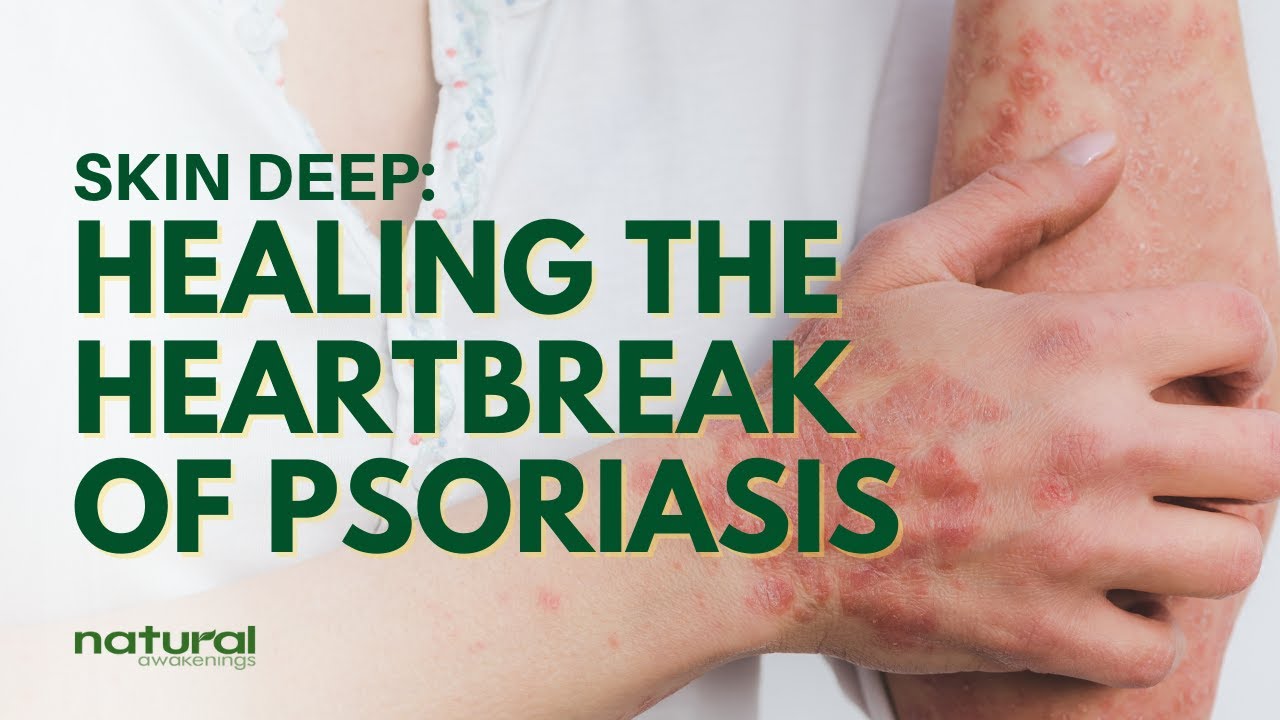 More than Skin Deep Healing the Heartbreak of Psoriasis - YouTube