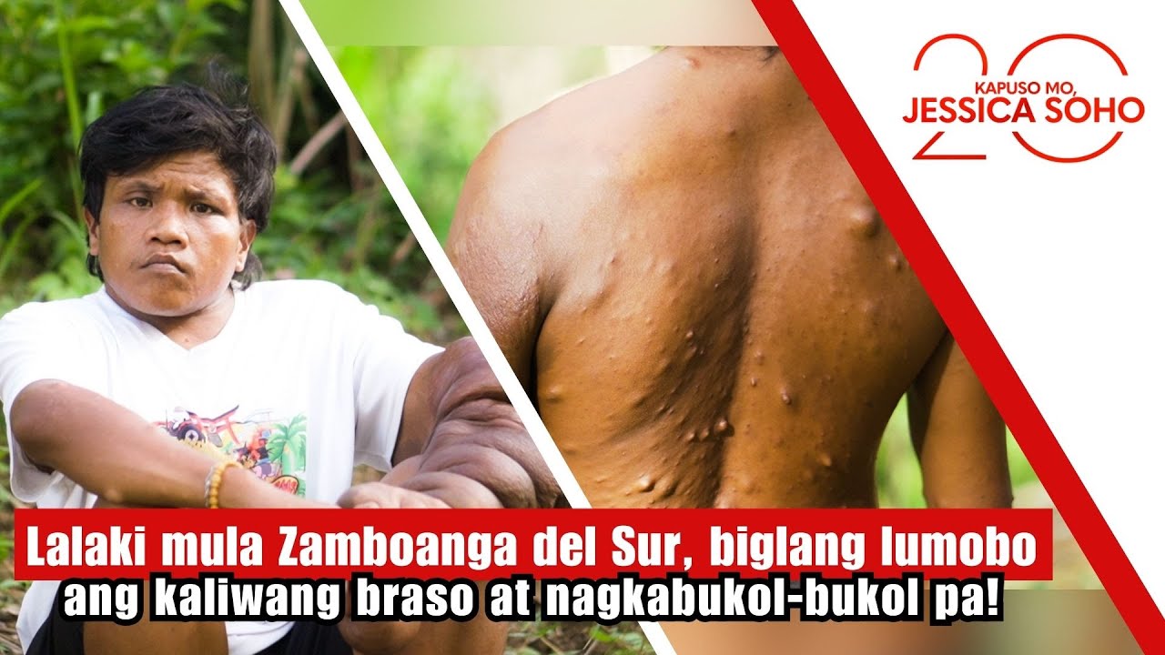 Lalaki, biglang lumobo ang kaliwang braso at nagkabukol-bukol pa ...