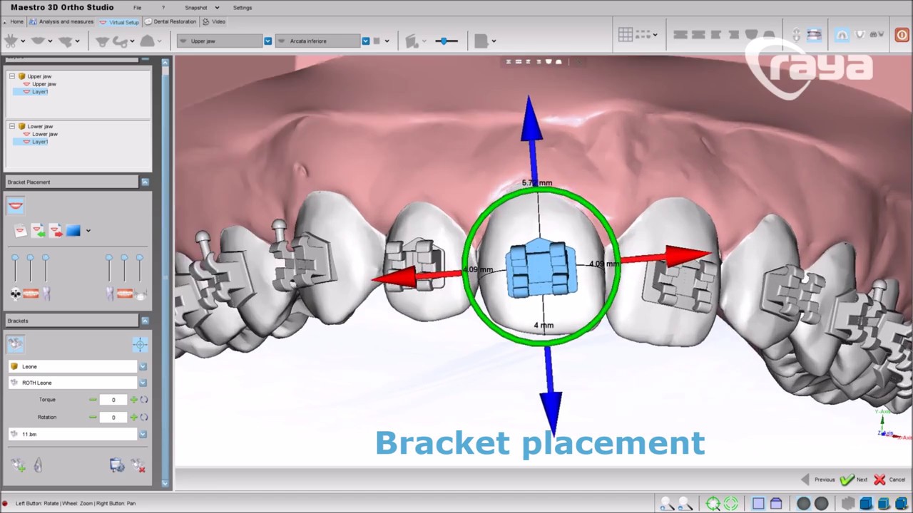 Cementado indirecto de Brackets / 3 Formas con Maestro3D Dental Studio ...
