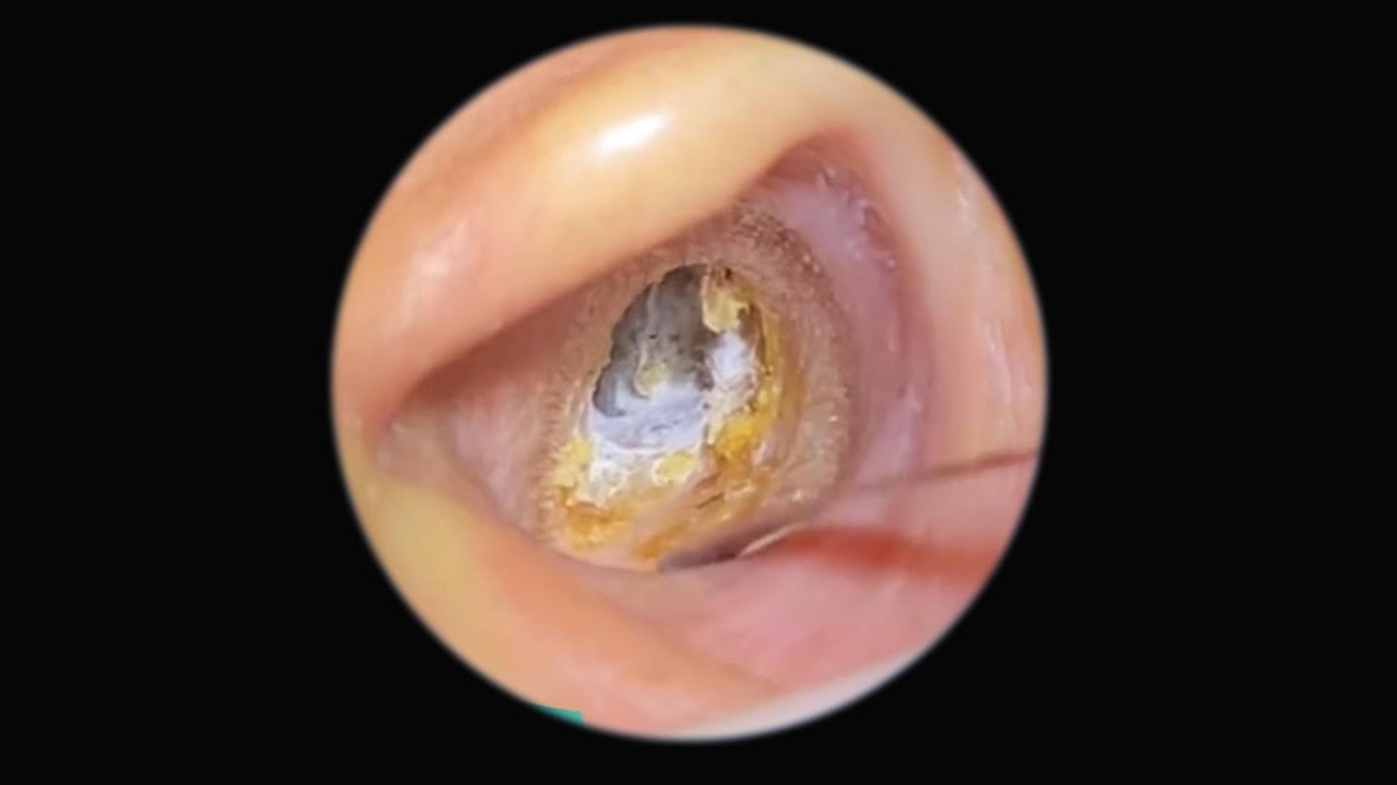 #49 - Large earwax mass found in young man's ear - YouTube