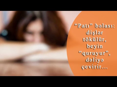 “Patı” bəlası: dişlər tökülür, beyin “quruyur”, dəliyə çevirir...