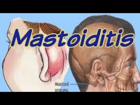 MASTOIDITIS KNOW ABOUT #PHLF - YouTube