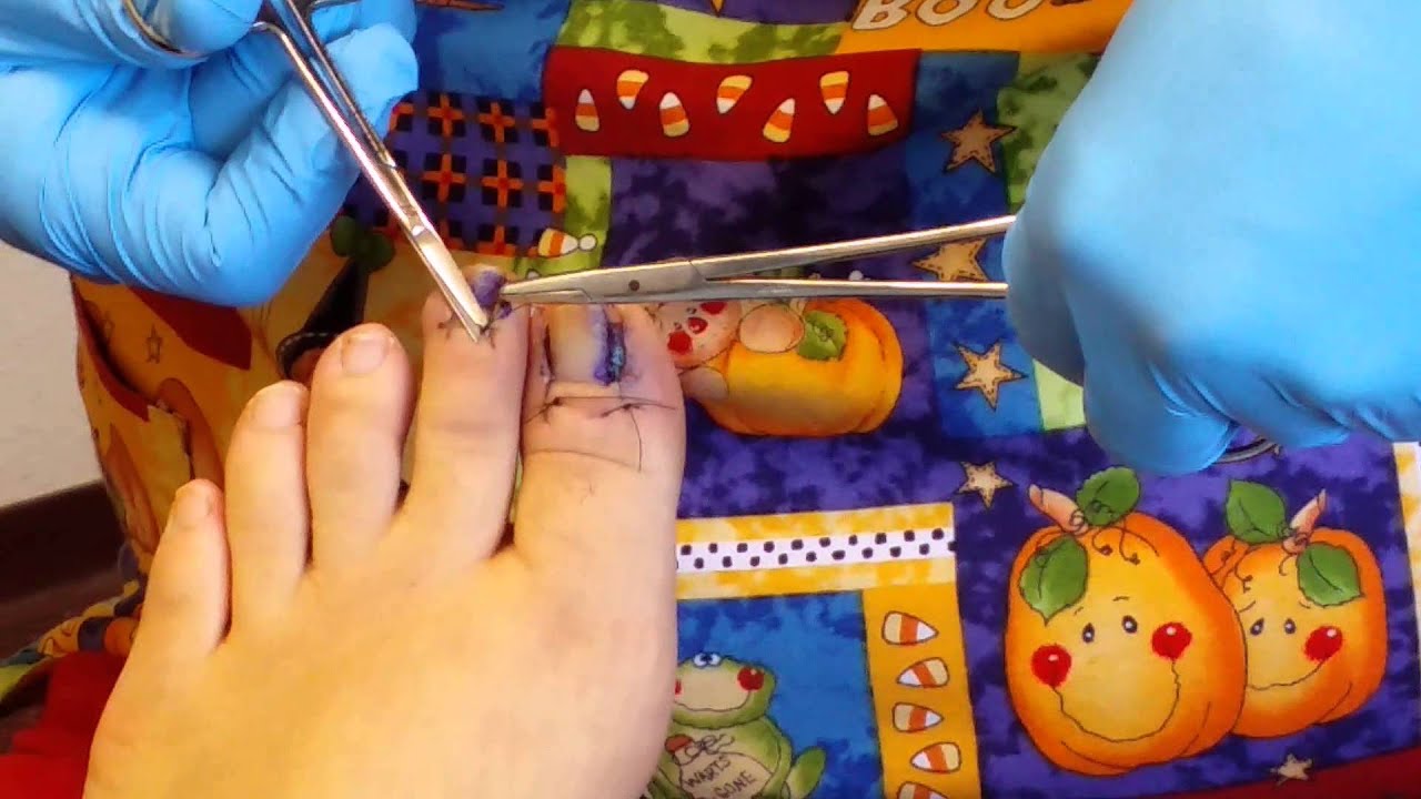 Ingrown toenail stitches removal - YouTube