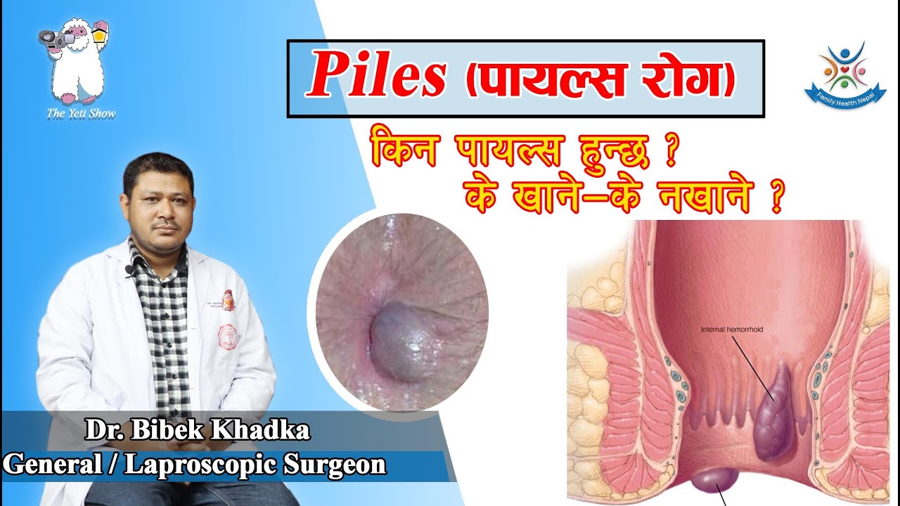 Piles -(पायल्स रोग) किन पायल्स हुन्छ ? के खाने—के नखाने ? Dr. Bibek ...