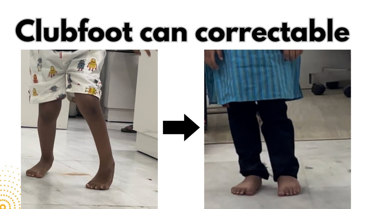 Relapse Clubfoot treatment , दोबारा टेडे हुए पैरों का इलाज़ ...