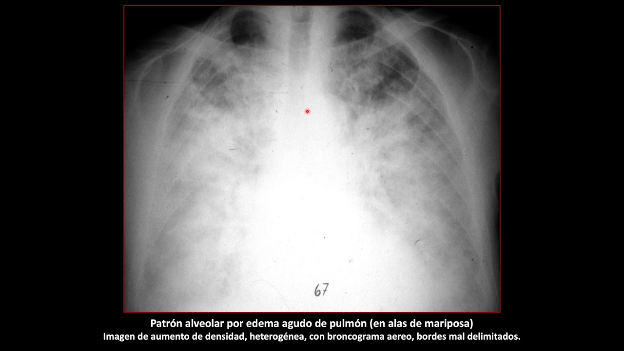 Clase Rx-Radiografia de tórax patológico-IDEAL PARA ESTUDIANTES Parte 2 ...