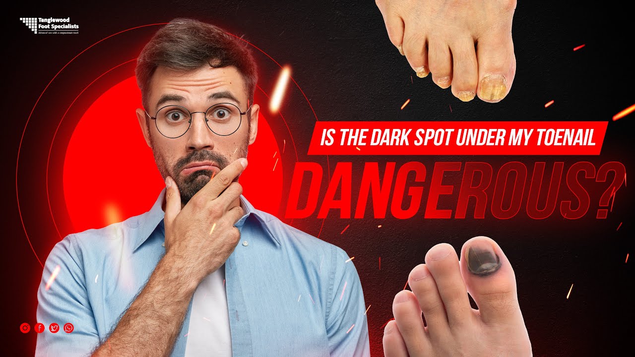 Is The Dark Spot Under My Toenail Dangerous YouTube is-the-dark-spot-under-my-toenail-dangerous-youtube