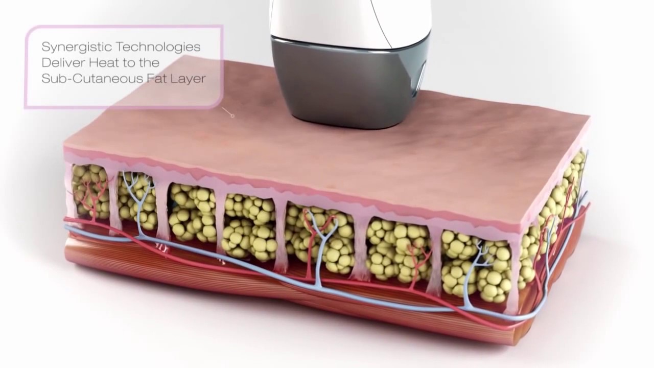 VelaShape III Treatment | Skin Institute by Marina K - YouTube