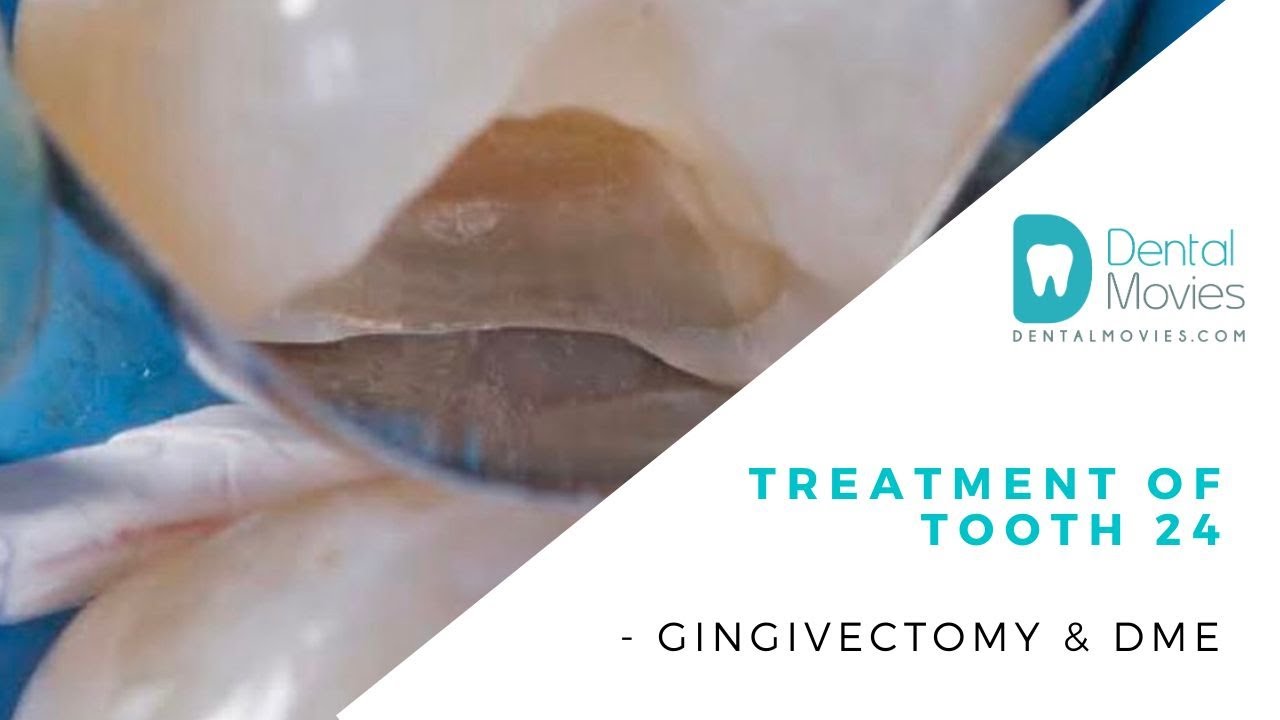 Treatment of tooth 24 - gingivectomy & DME - YouTube
