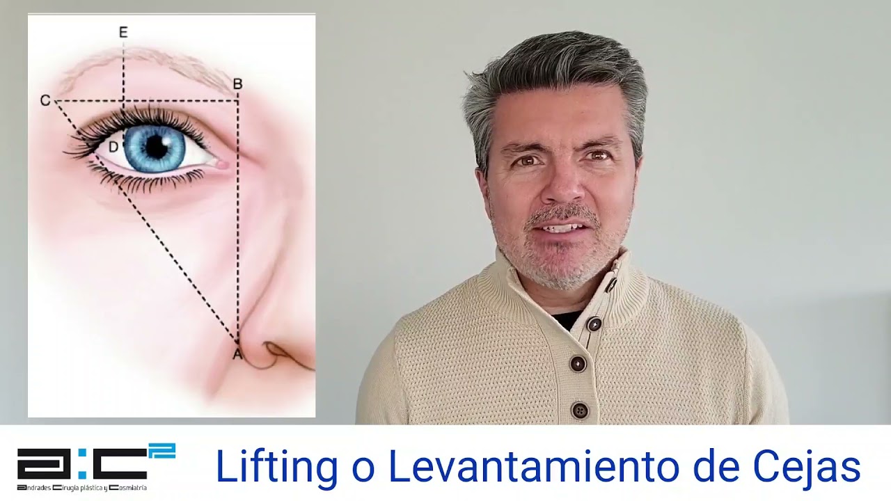 Lifting o Levantamiento de Cejas - YouTube