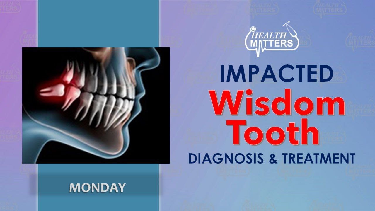 Impacted Wisdom Tooth: Diagnosis & Treatment | Health Matters | July 29 ...