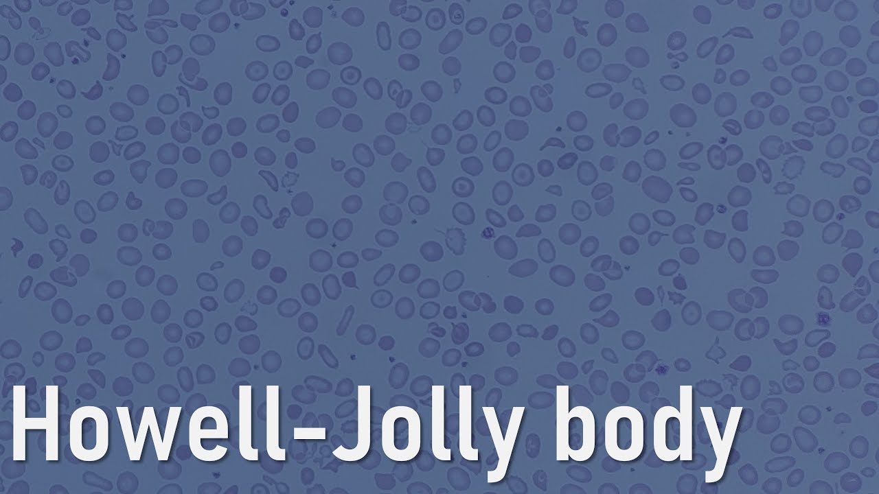 Red cells: Howell-Jolly bodies - YouTube