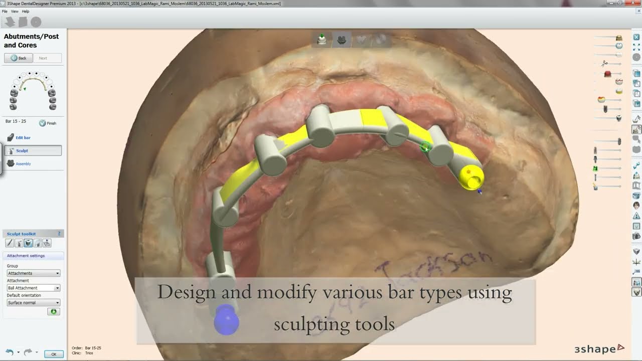 How to design an Implants Bar in 3Shape - YouTube