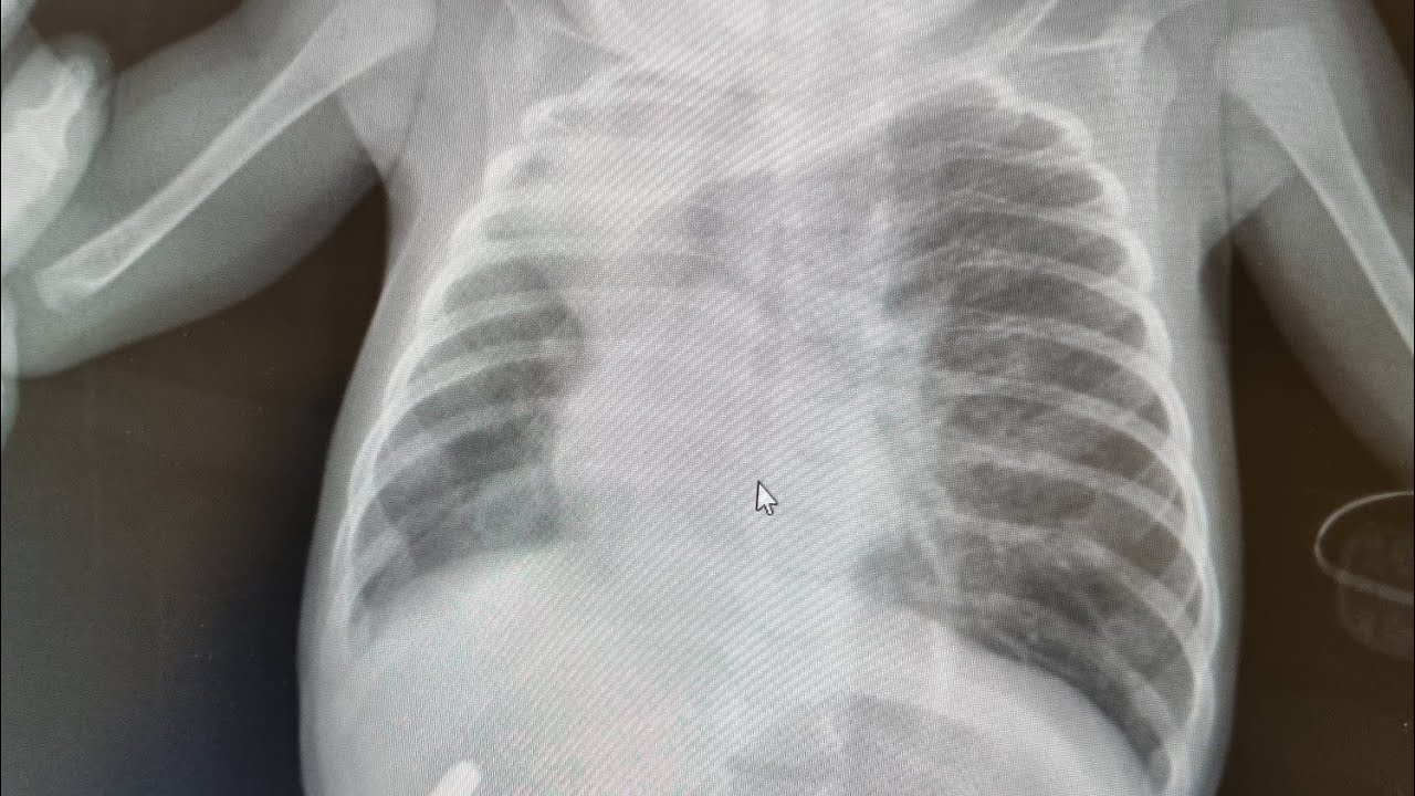 Right upper lobe consolidation, collapse - YouTube