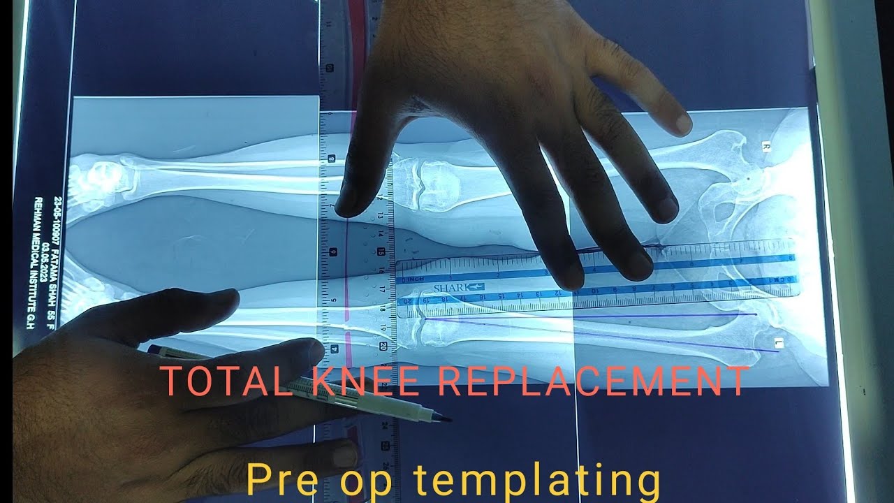 Total Knee Replacement Pre Op Templating Youtube