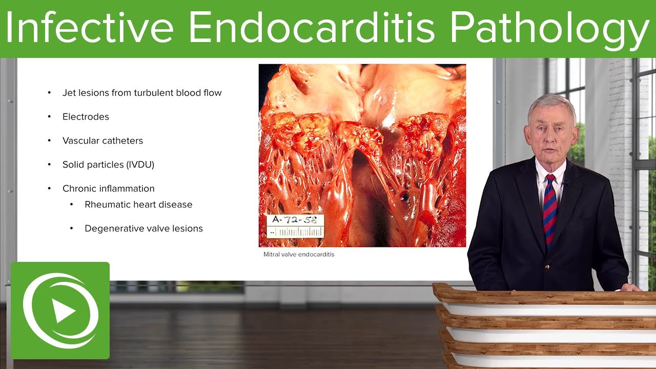 Infective Endocarditis (IE): Pathology – Infectious Diseases | Lecturio ...