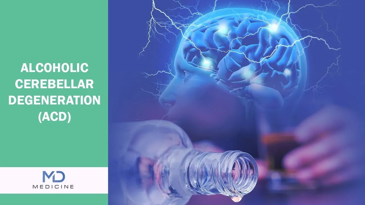 Alcoholic Cerebellar Degeneration (ACD): A Complex Neurological ...