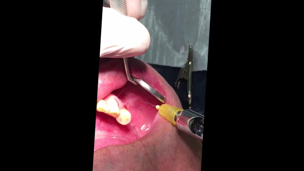 Bloqueio do nervo mentoniano - YouTube