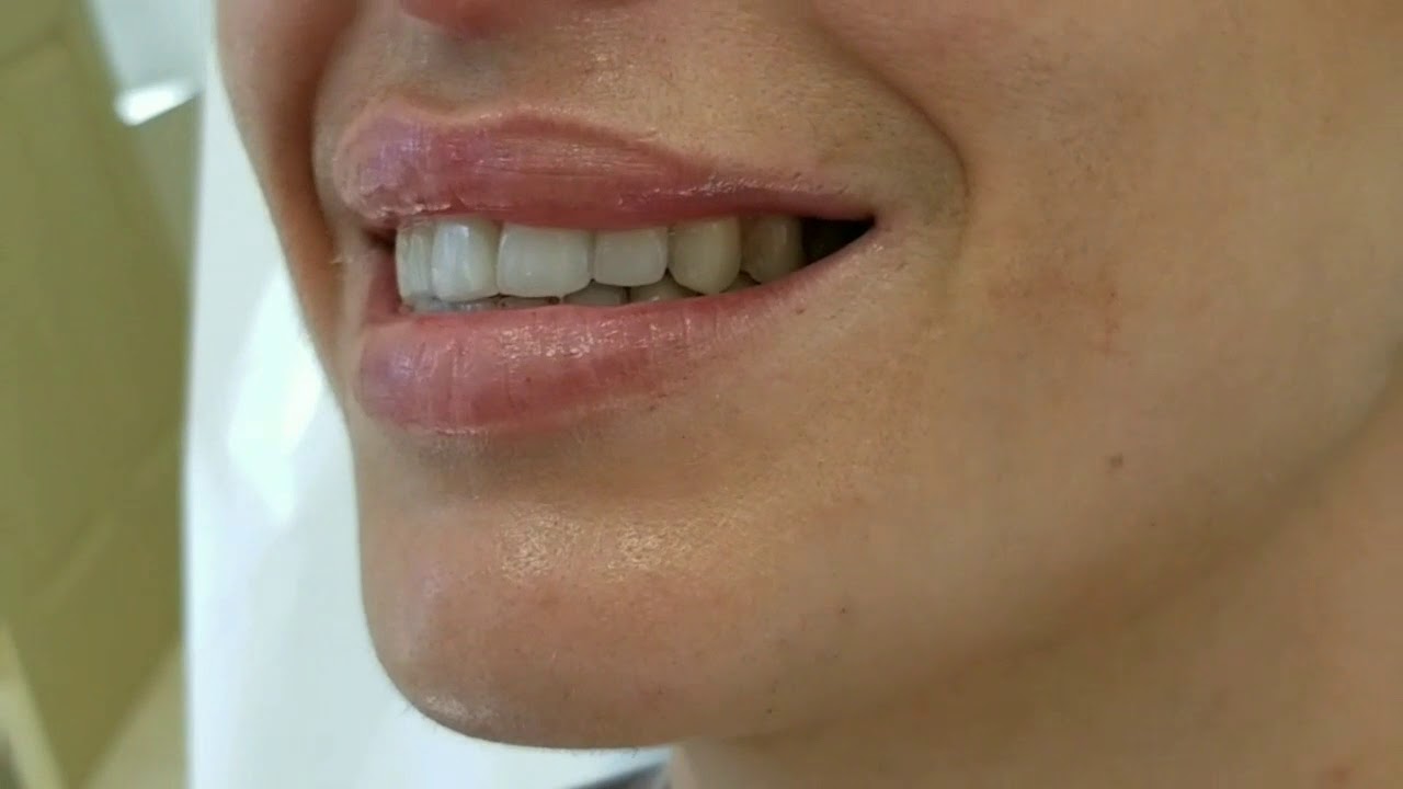 Asymmetrical lips correction, lips Injection, filler, cosmetic, Marco's ...