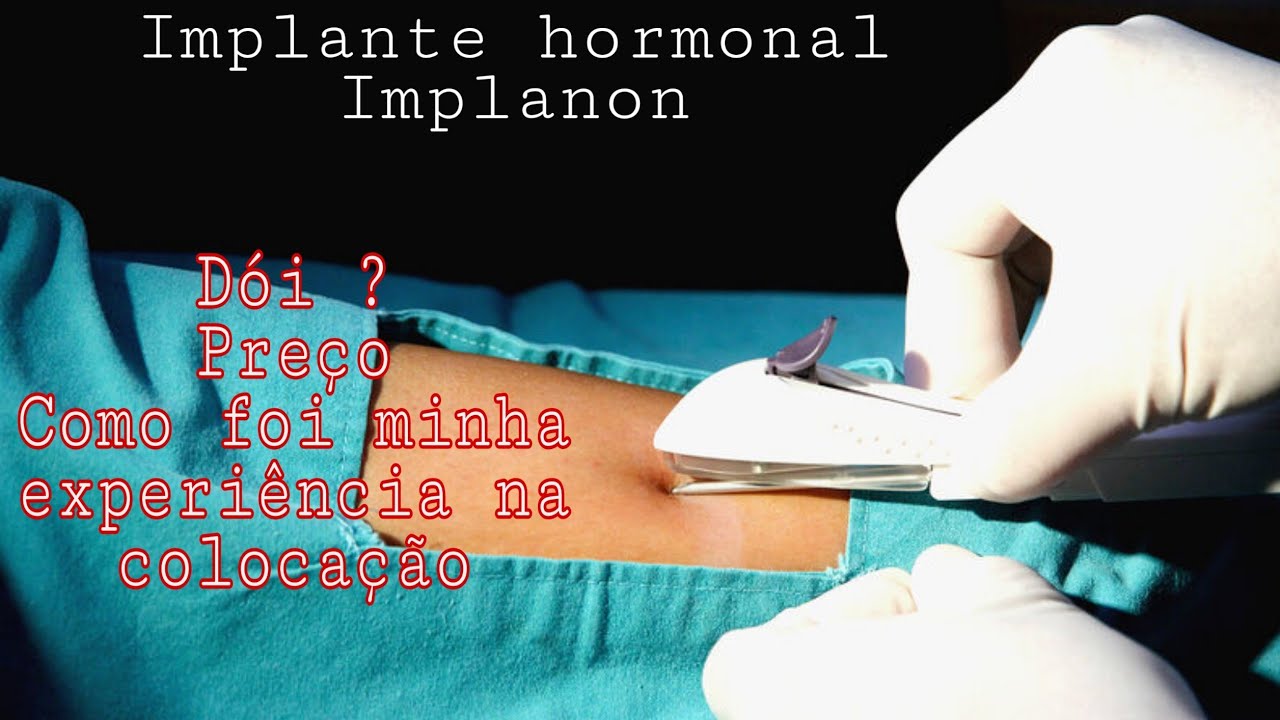 IMPLANTE ANTICONCEPCIONAL - YouTube