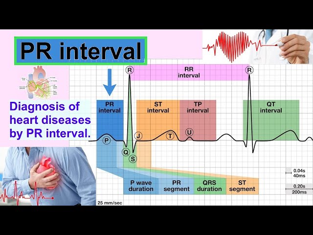 Prolonged Pr Interval