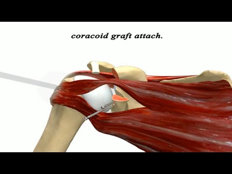 Latarjet surgery for recurrent anterior shoulder dislocation with bony ...