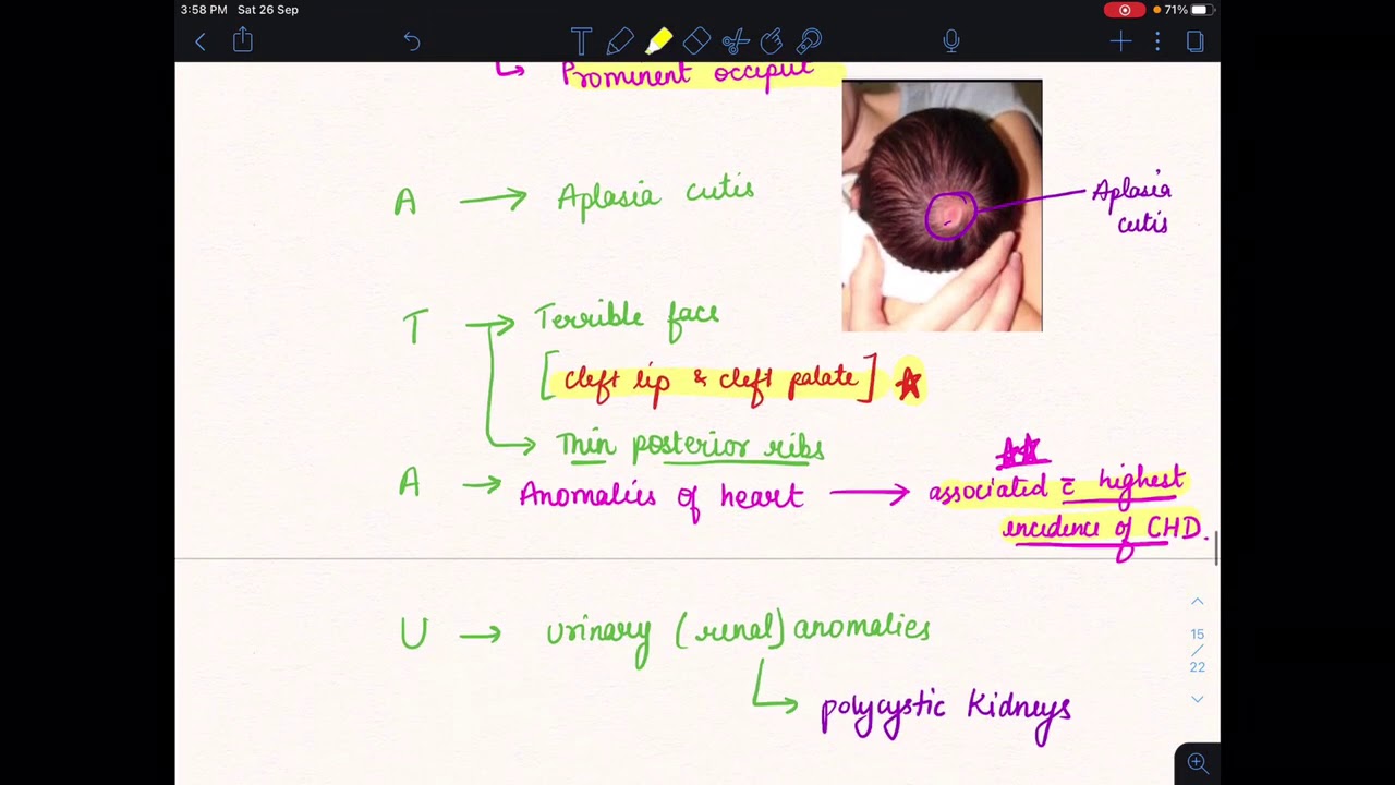 Patau syndrome mnemonic - YouTube