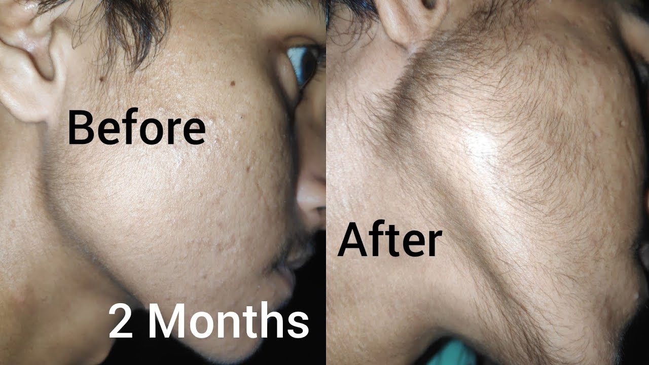Dadhi Kaise badhaen | Forest Hair Vitamins for Beard Growth | Full ...