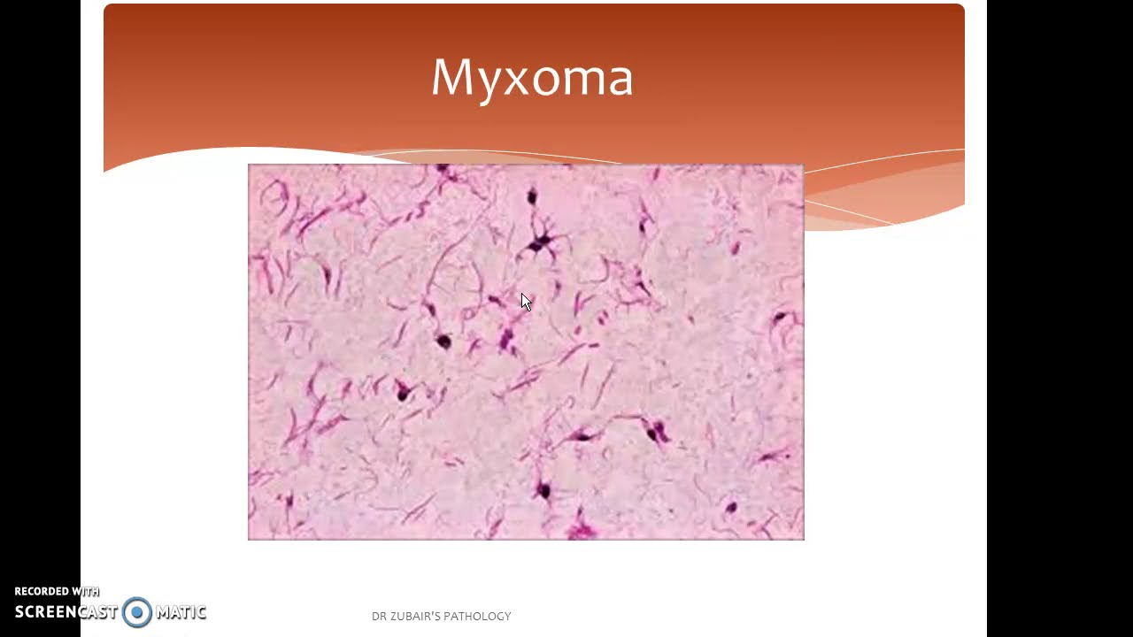 HYALINE CHANGE AND MUCOID CHANGE - YouTube