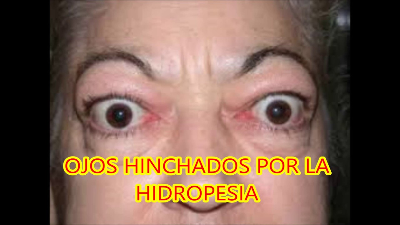 Que Es La Hidropesia Youtube