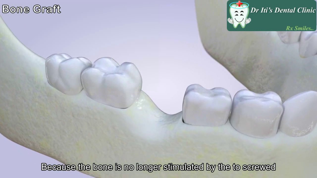 Bone Grafting -Missing tooth leads to bone loss,which needs bone ...