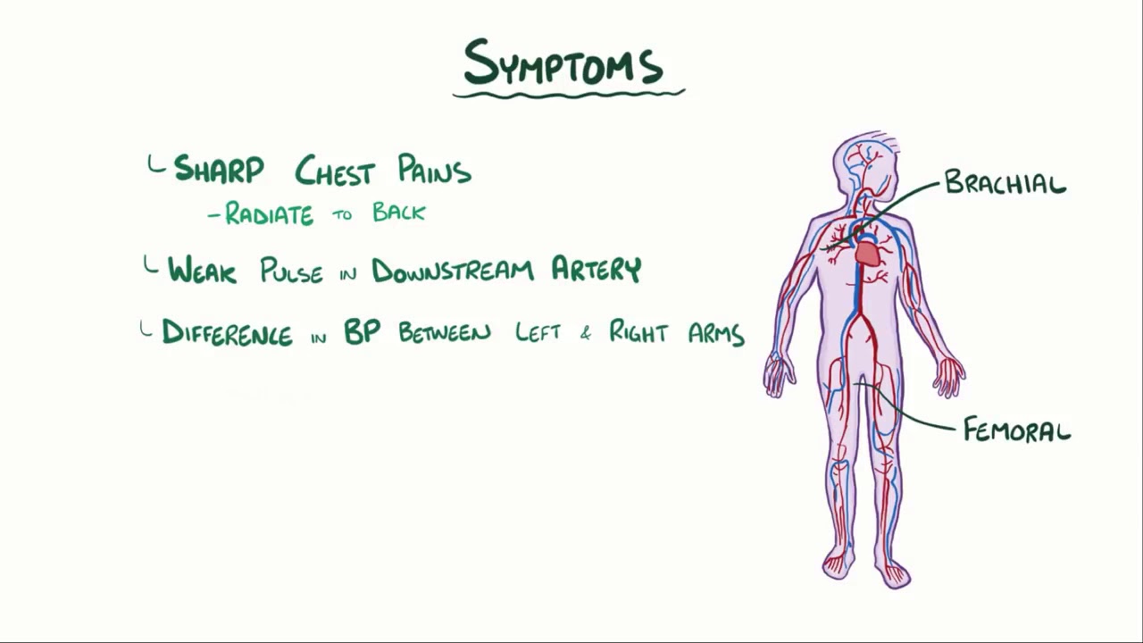 Aortic Dissection causes, symptoms, diagnosis, treatment, pathology ...