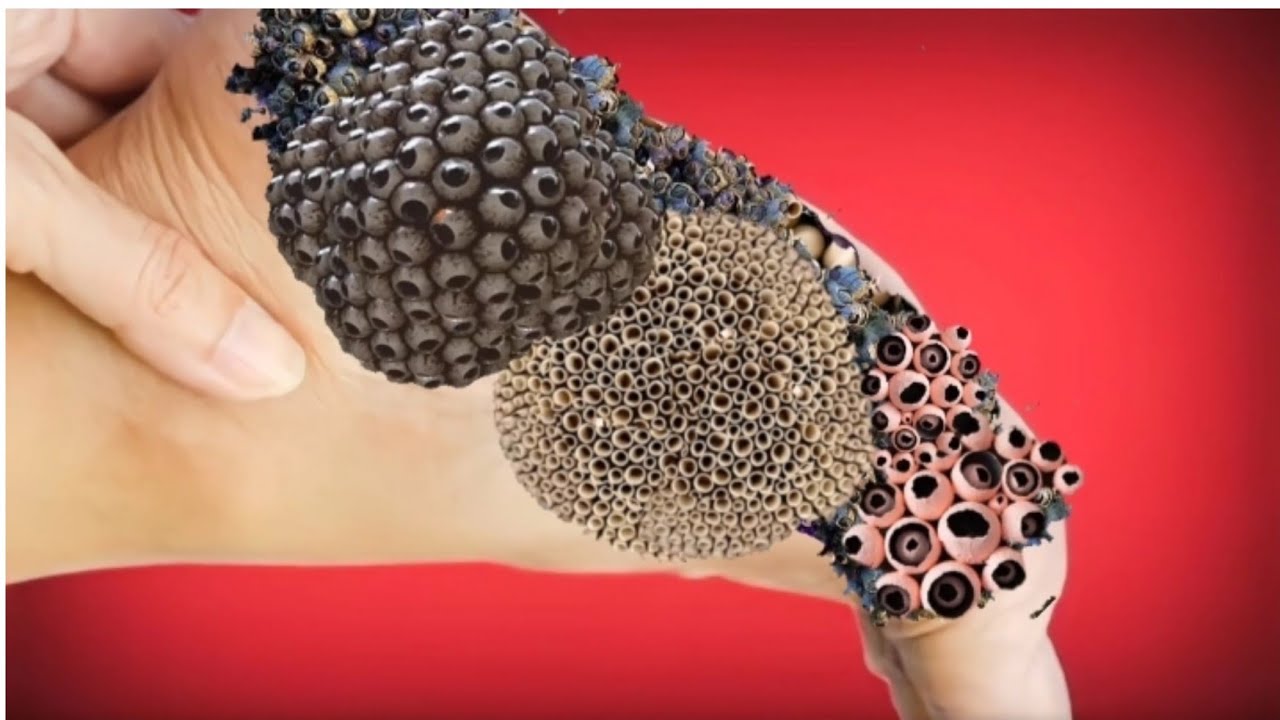 ASMR Severely Affected Bryozoan Trypophobia Insect Infected Toe | ASMR Foot🦶 Treatment Animation ...