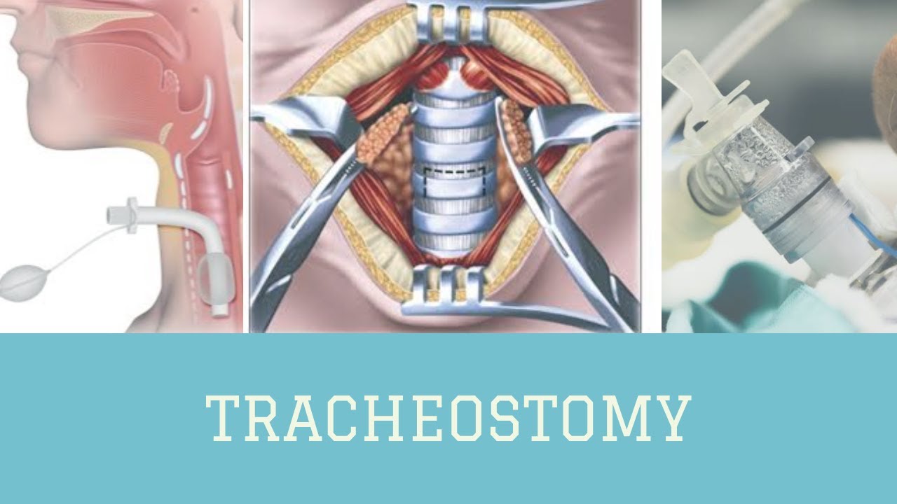 TRACHEOSTOMY | The White Army - YouTube