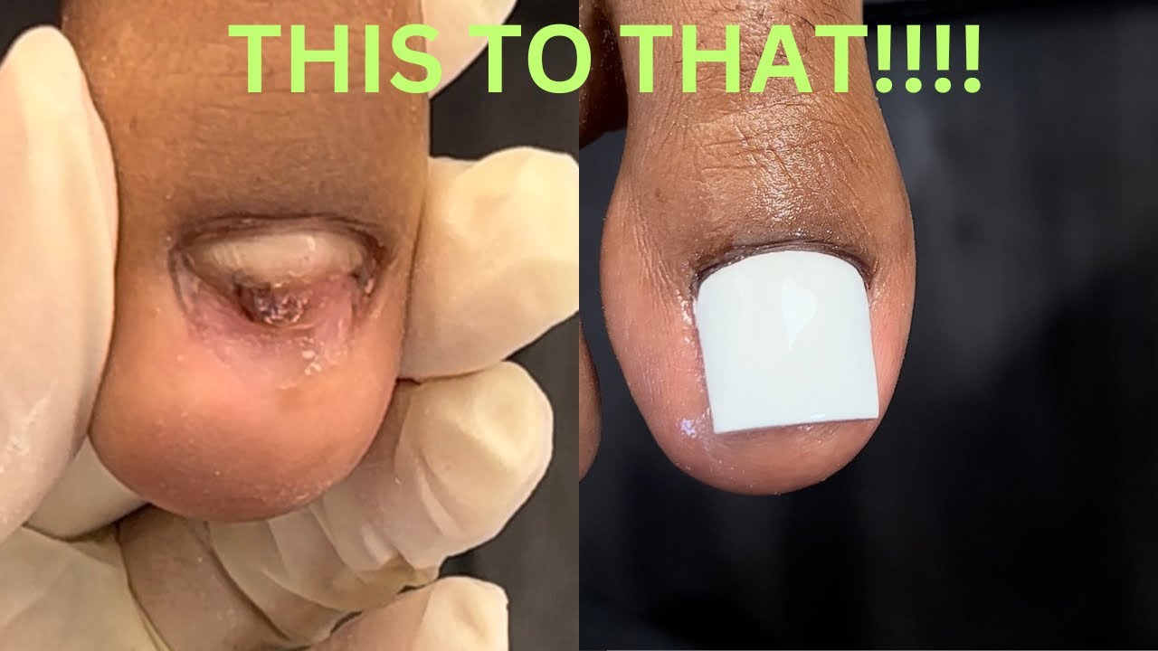 RECONSTRUCTION TOE | OVERLAY ACRYLIC TOES - YouTube