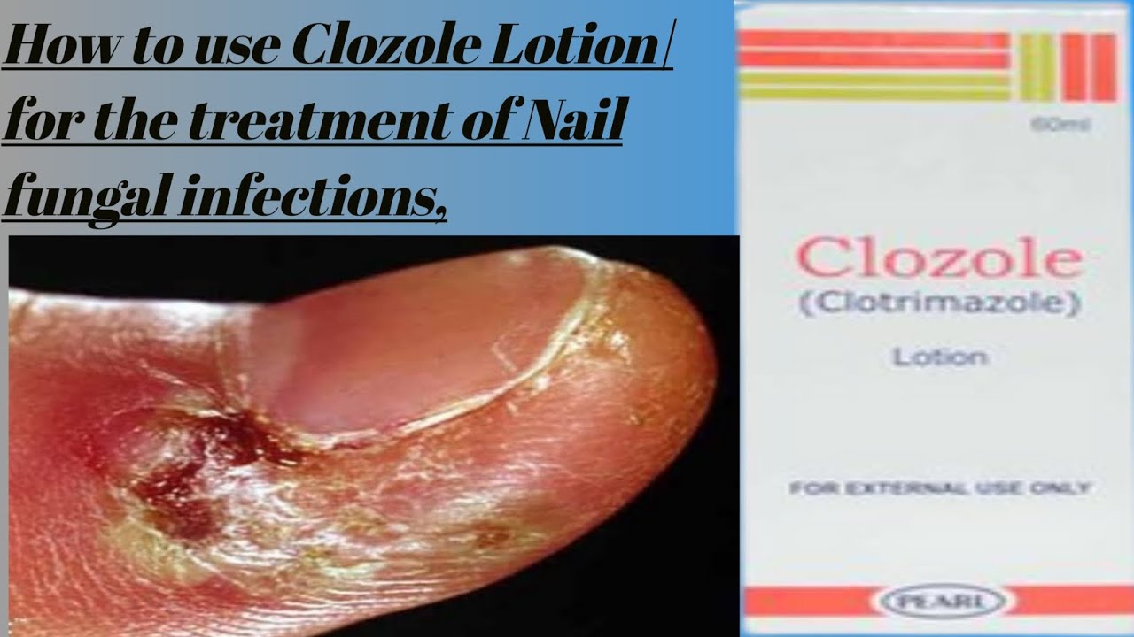 How to use Clozole Lotion|For the treatment of Nail fungal infections# ...