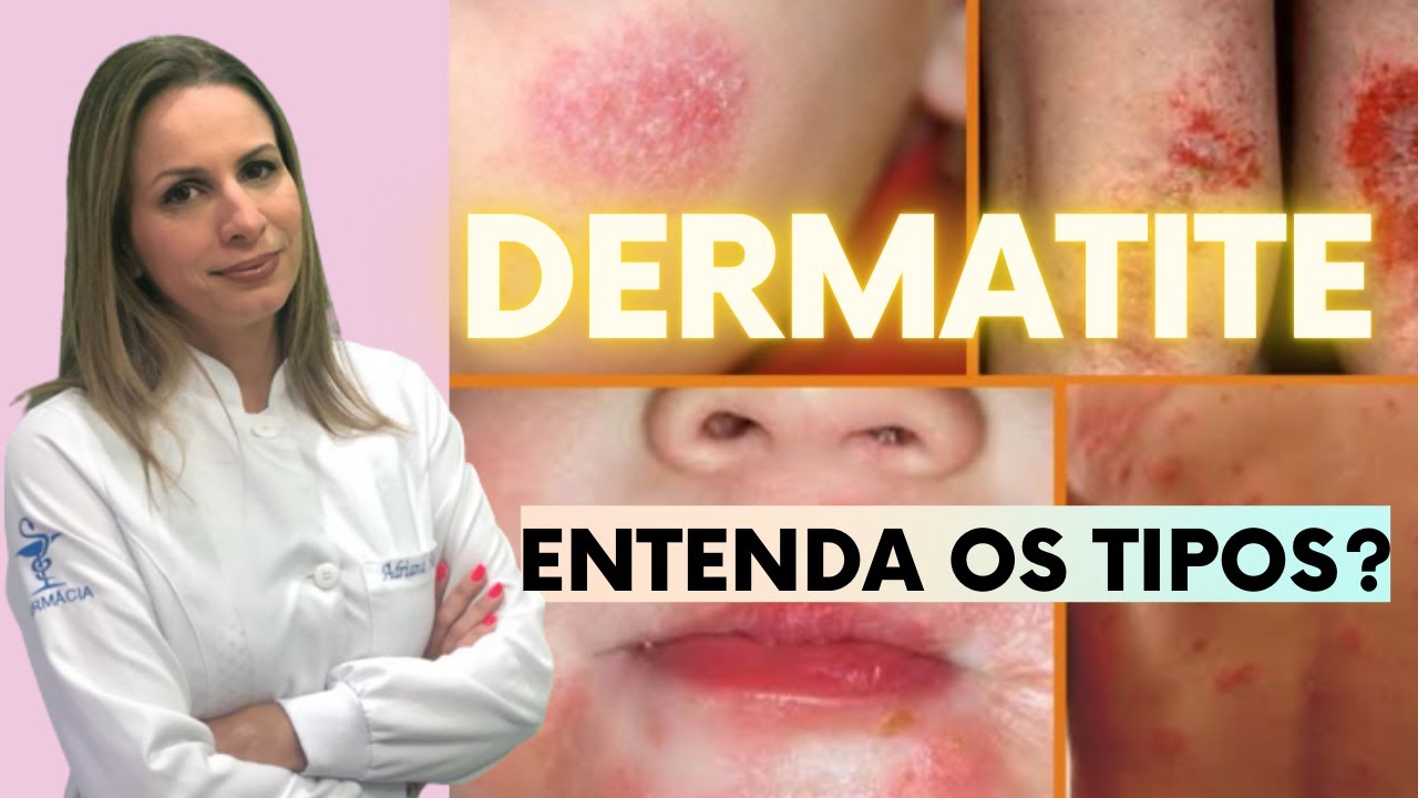SAIBA OS TIPOS DE DERMATITE ANTES DE INICIAR O TRATAMENTO! - YouTube