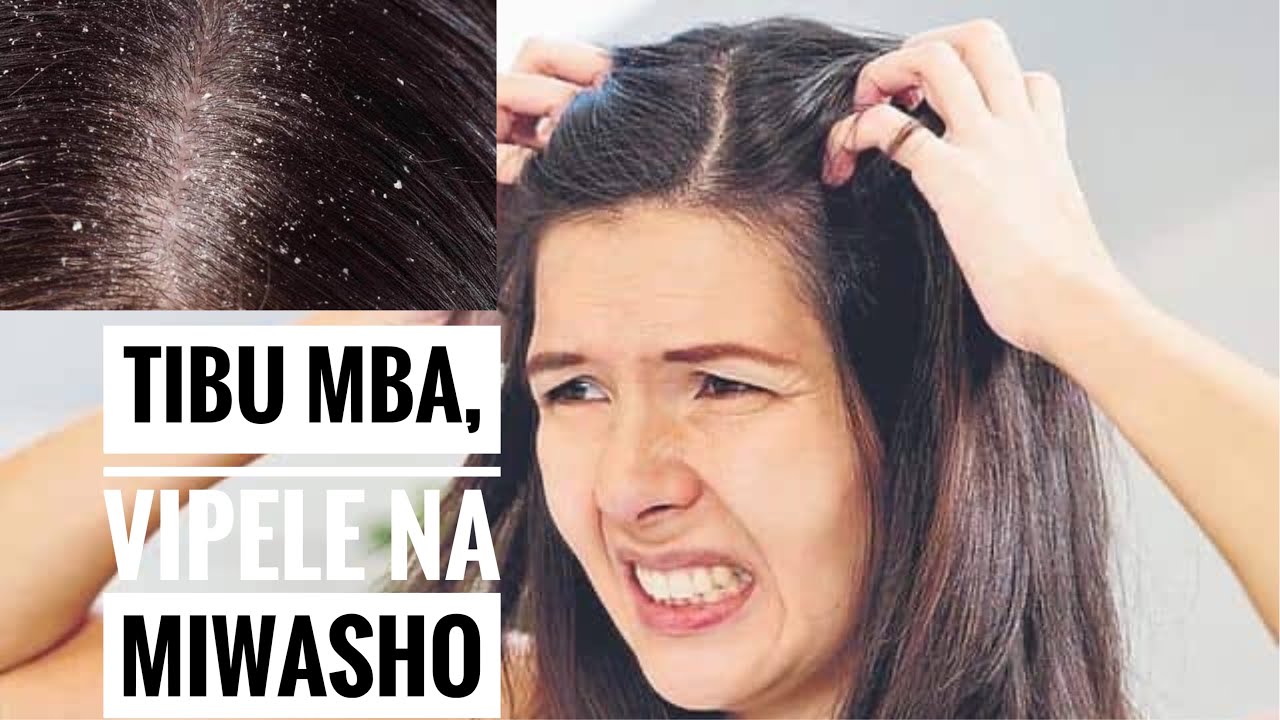 Jinsi yakuondoa muwasho, mba, mapunye kichwani/jinsi yakutibu mba ...