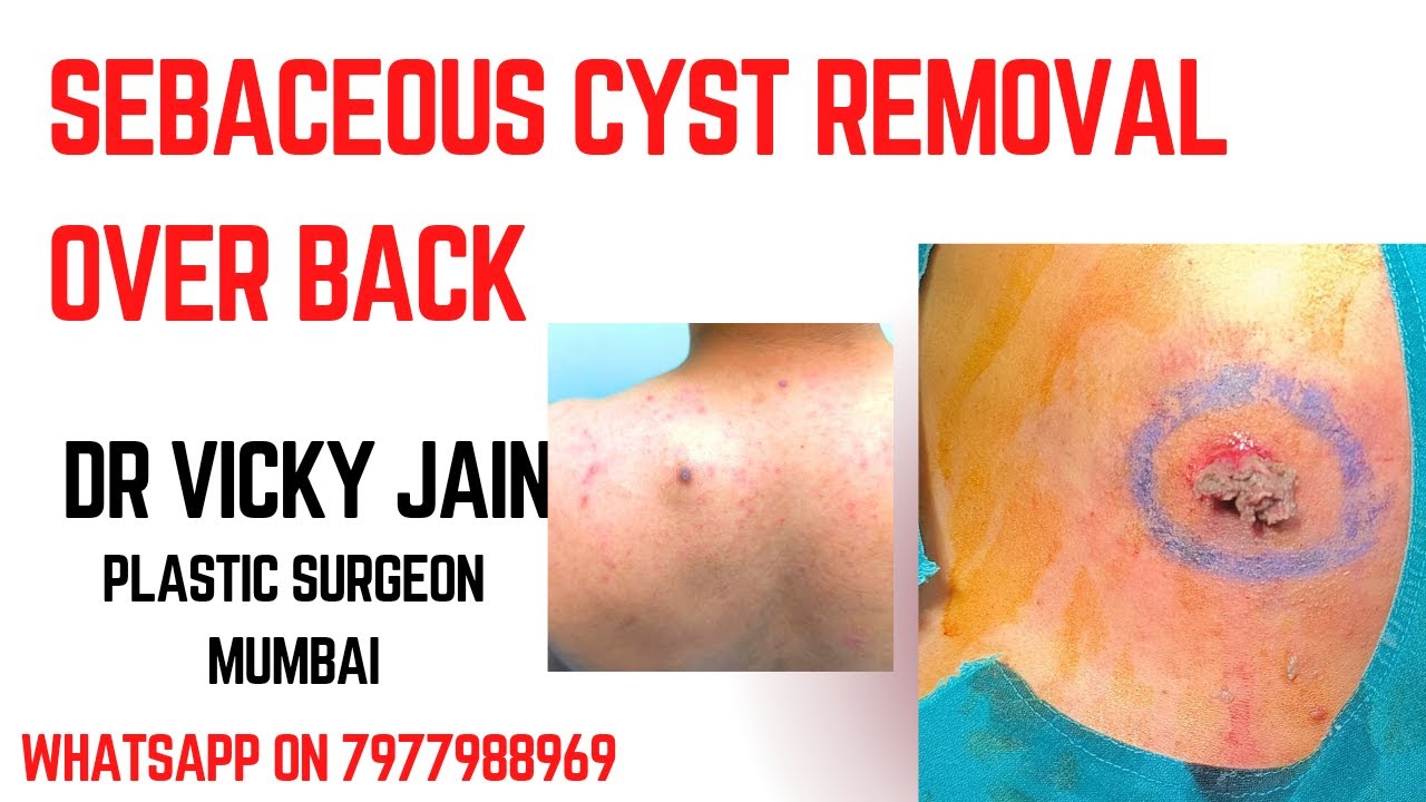 Sebaceous Cyst Removal Surgery:The Process Explained #cystpoping # ...
