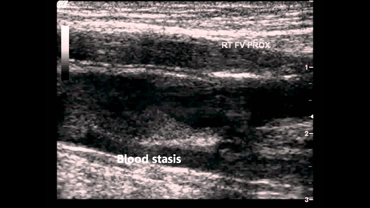 Blood stasis in venous valve - YouTube