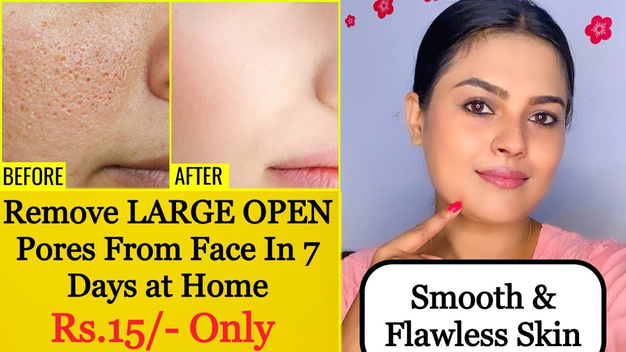 Remove large Open Pores In 15 Days At Home || Rid Blackheads & Whiteheads Large Pores, Acne ...