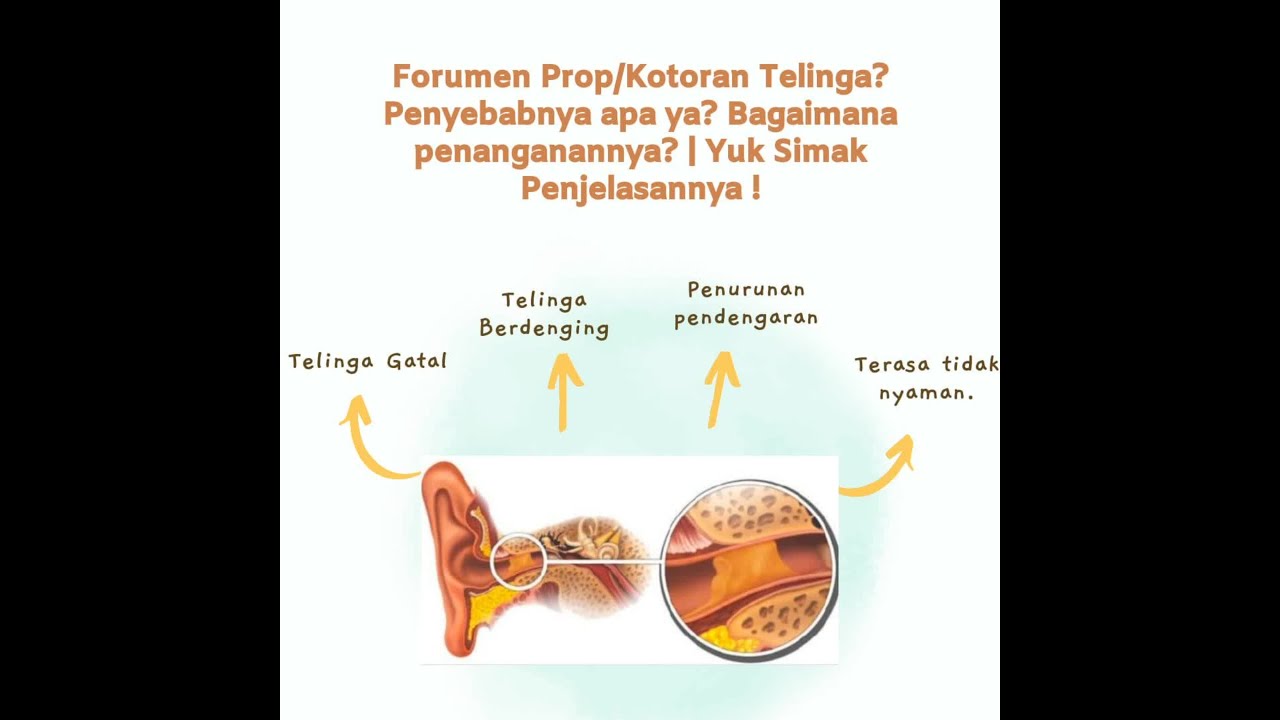 Serumen Prop/Kotoran Telinga | Apa Penyebab, dan Bagaimana ...