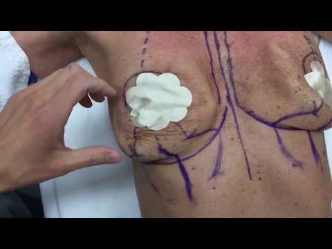 Breast Implant Revision / Correction - Before and After -   Dr  Anthony Youn