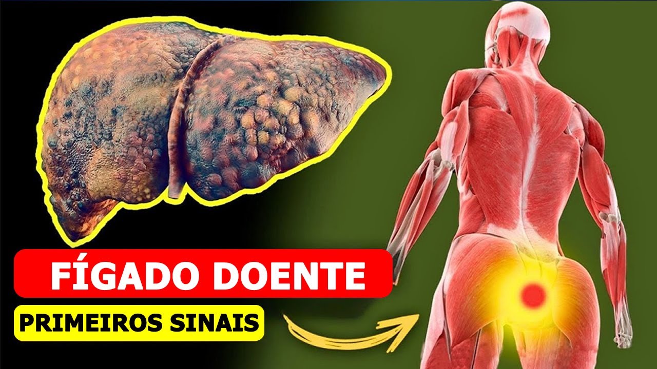 6 Primeiros Sinais de CIRROSE HEPÁTICA e FÍGADO DOENTE - YouTube