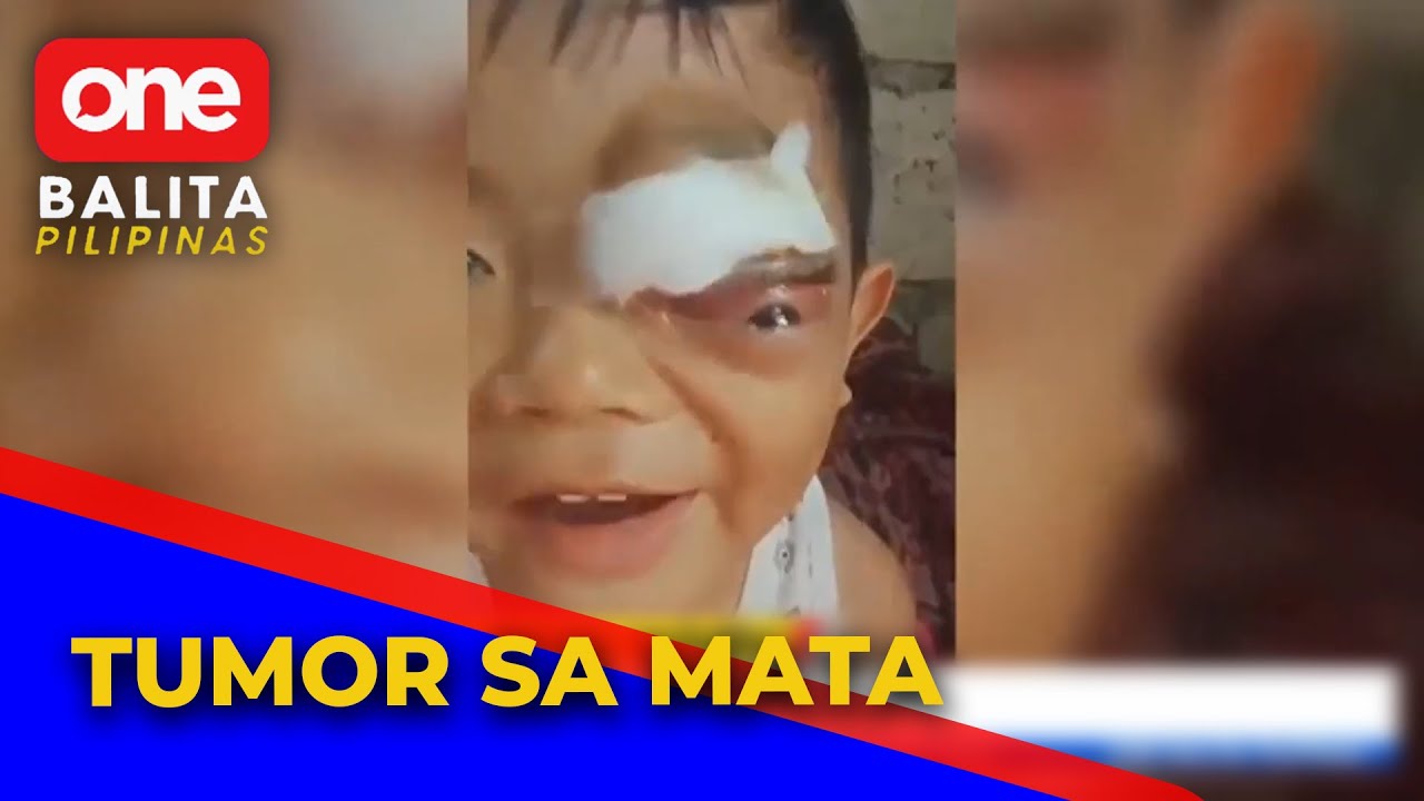4-anyos na lalaki, tinubuan ng bukol sa mata - YouTube