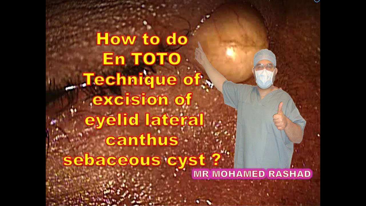 How to do En TOTO Technique for excision of lateral Canthus Eyelid ...