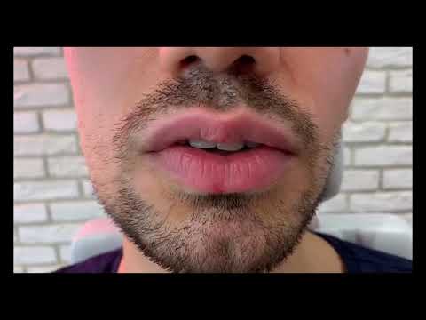 Ses Kalınlaştırma Ameliyatı, Prof. Dr. Kürşat Yelken