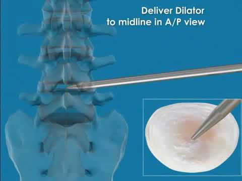 OLLIF KLIF Procedure Animation Short - YouTube