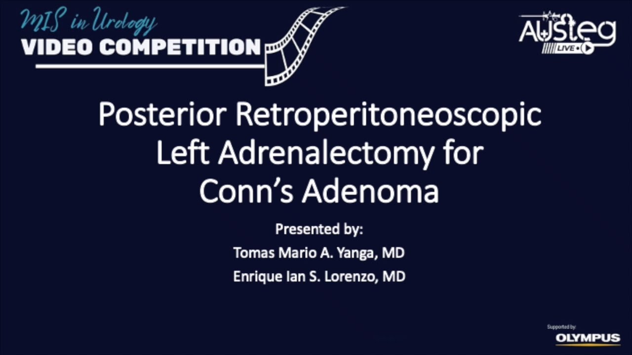 Posterior Retroperitoneoscopic Left Adrenalectomy for Conn's Adenoma ...